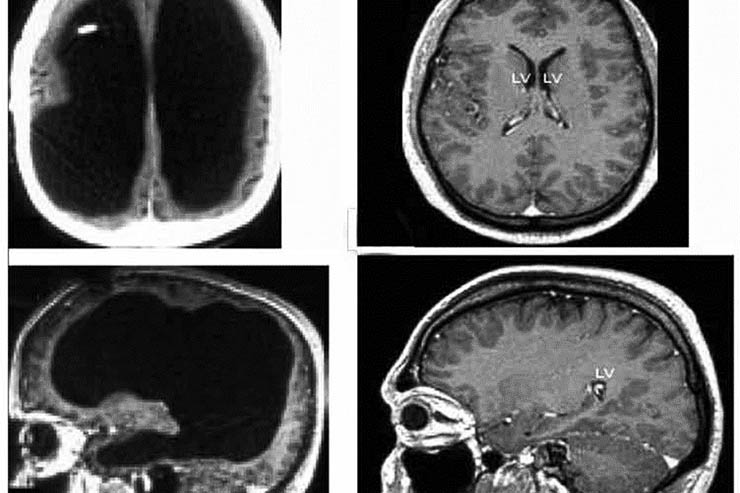 Is the Brain Really Necessary? The Answer Seems to be a No-Brainer ...